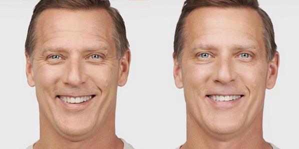 Your Guide to Botox for Men | California Skin Institute
